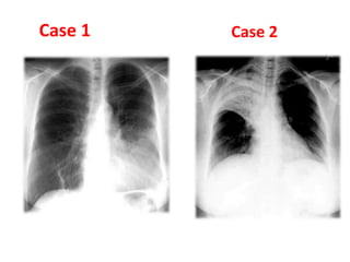 Understanding and Reading of Chest X-Rays | PPTX