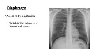 CHEST XRAY INTERPRETATION . A SLIDE IN CSH | PPTX