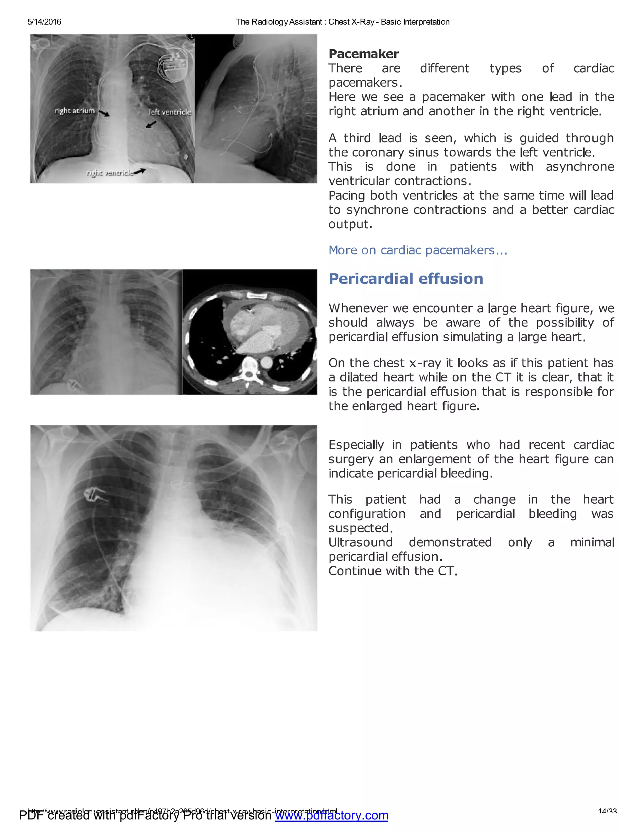 Chest x ray - basic interpretation | PDF