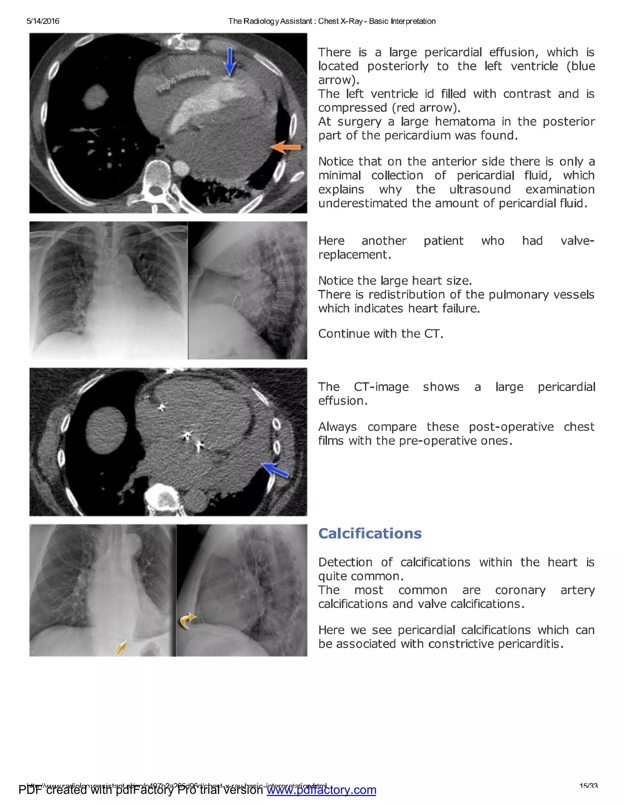 Chest x ray - basic interpretation | PDF