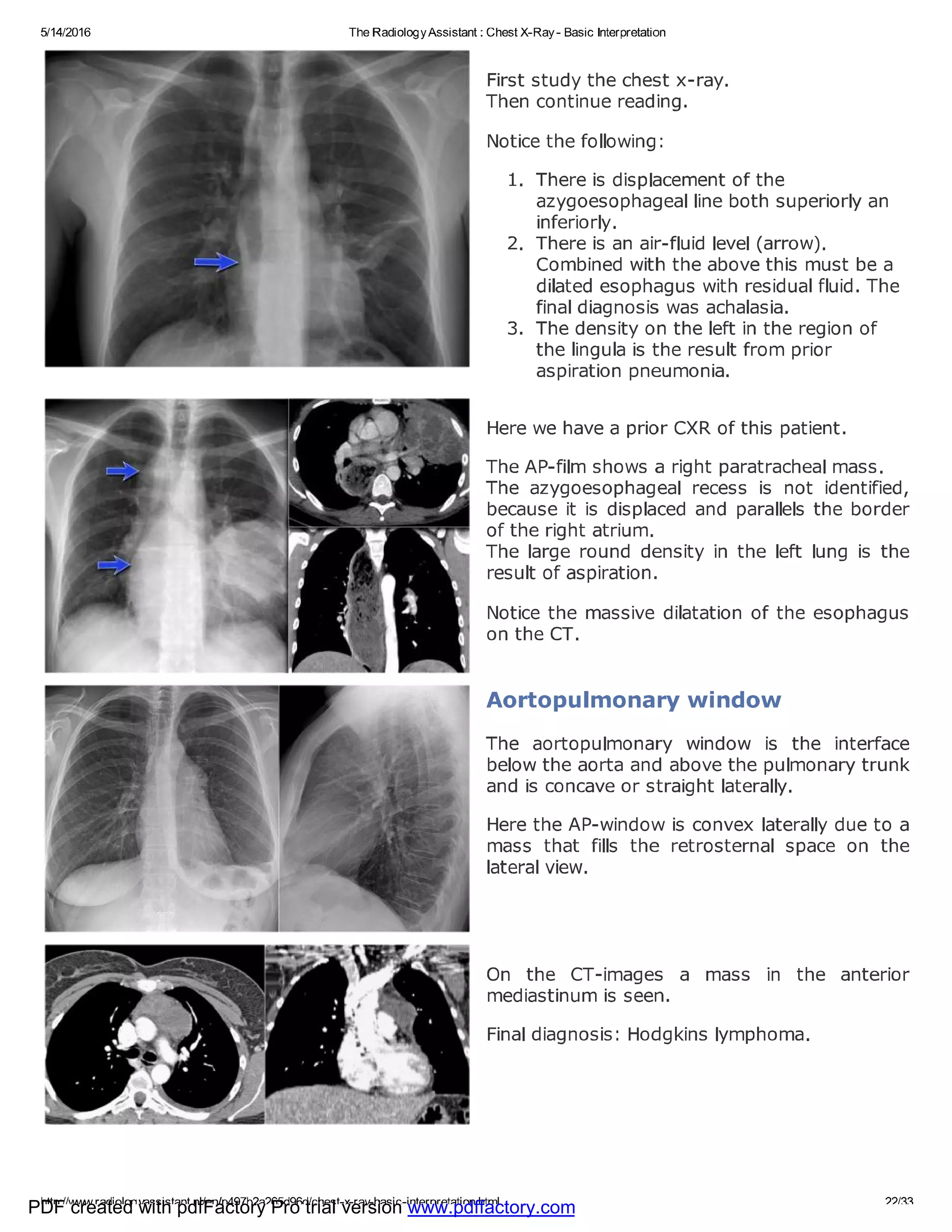 Chest x ray - basic interpretation | PDF