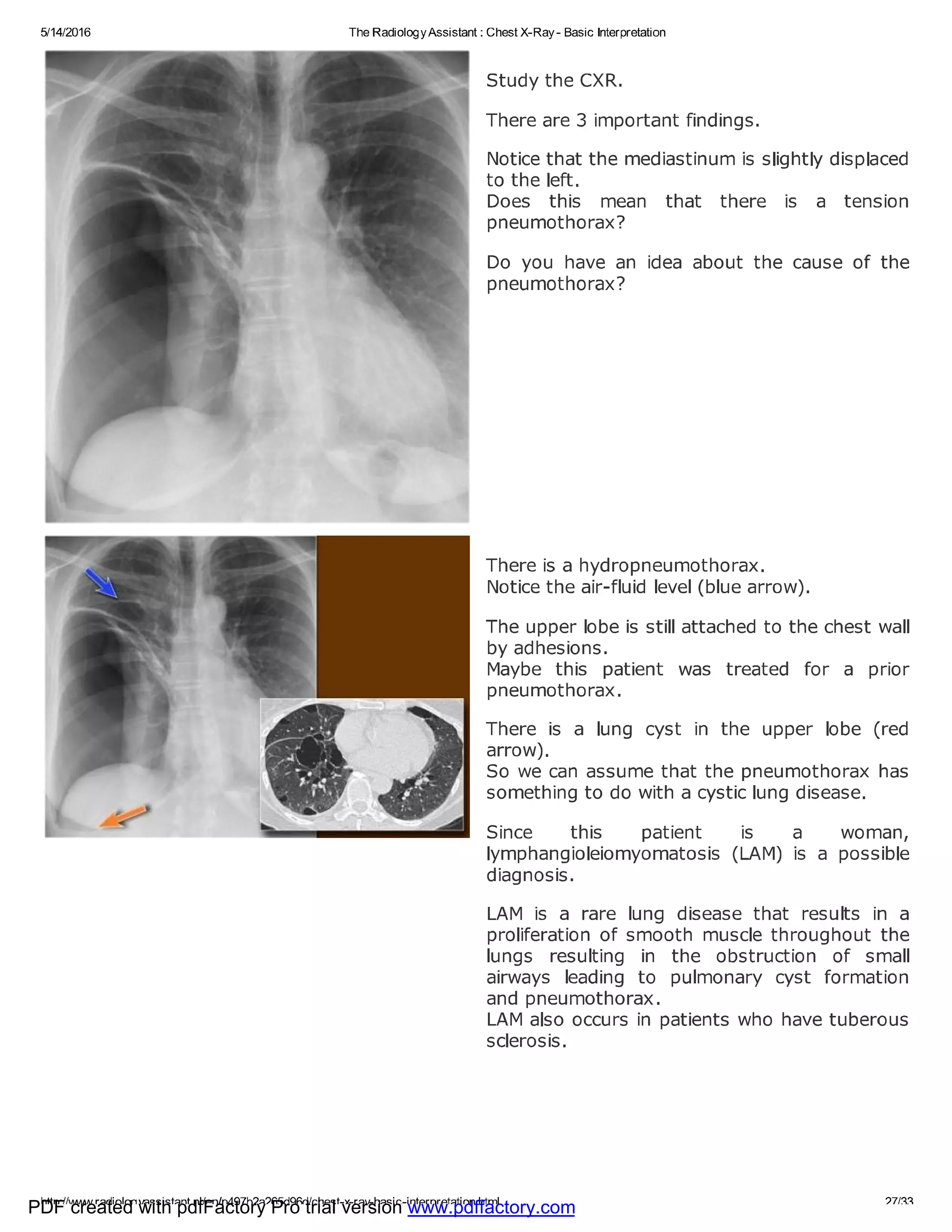 Chest x ray - basic interpretation | PDF