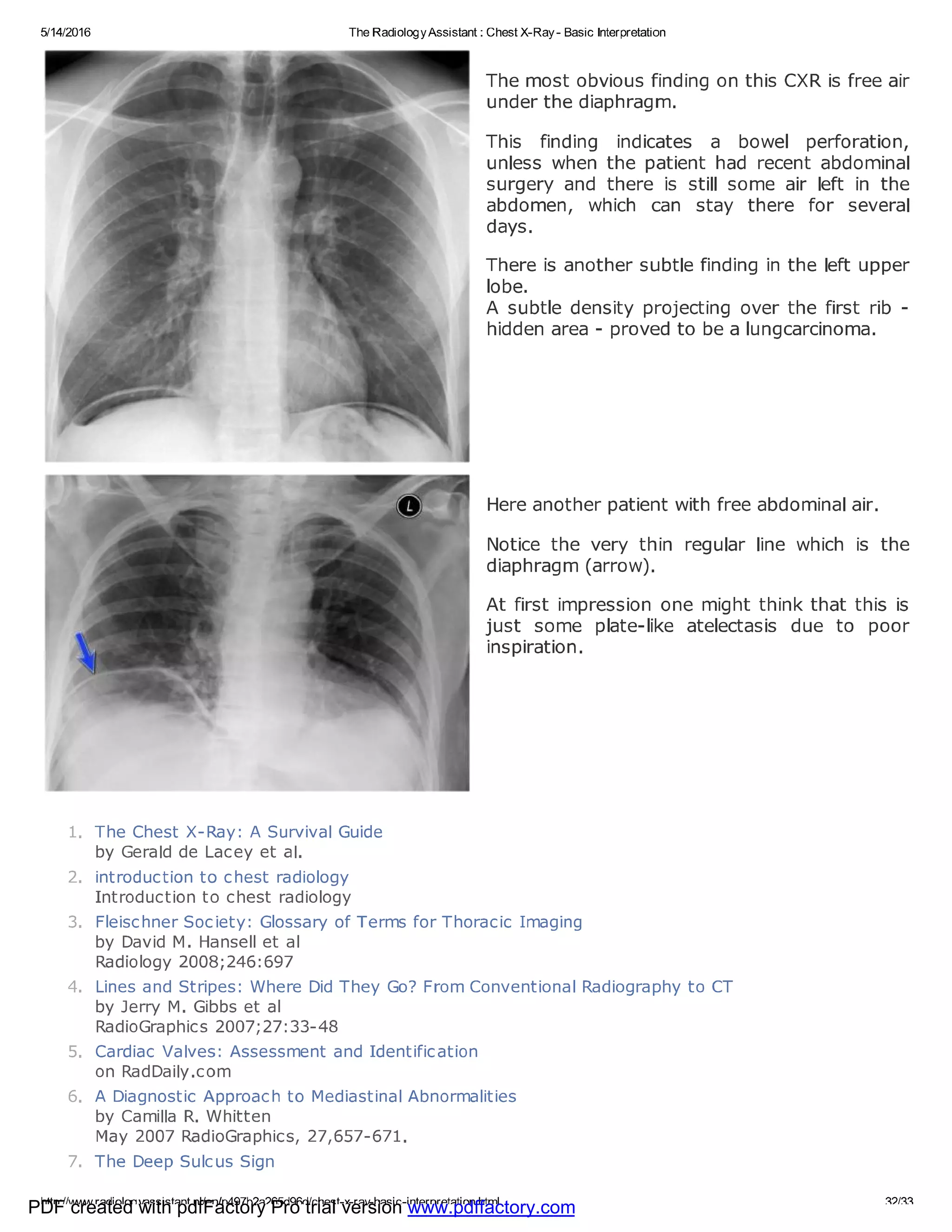 Chest x ray - basic interpretation | PDF