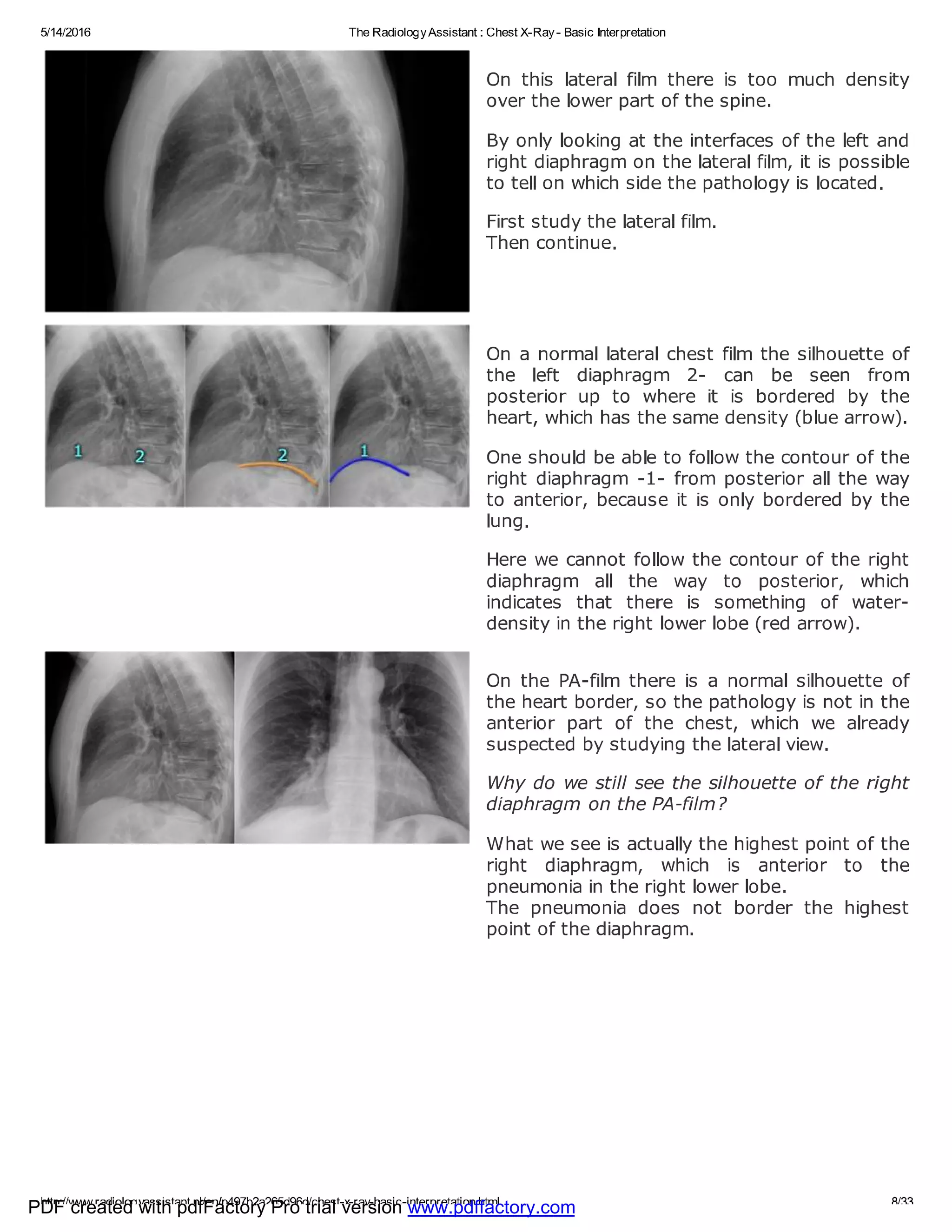 Chest x ray - basic interpretation | PDF