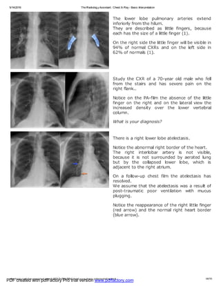 Chest x ray - basic interpretation | PDF