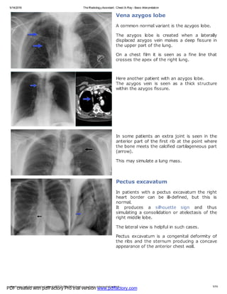 Chest x ray - basic interpretation | PDF