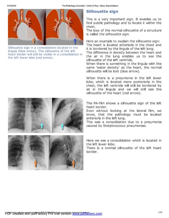 Chest x ray - basic interpretation | PDF