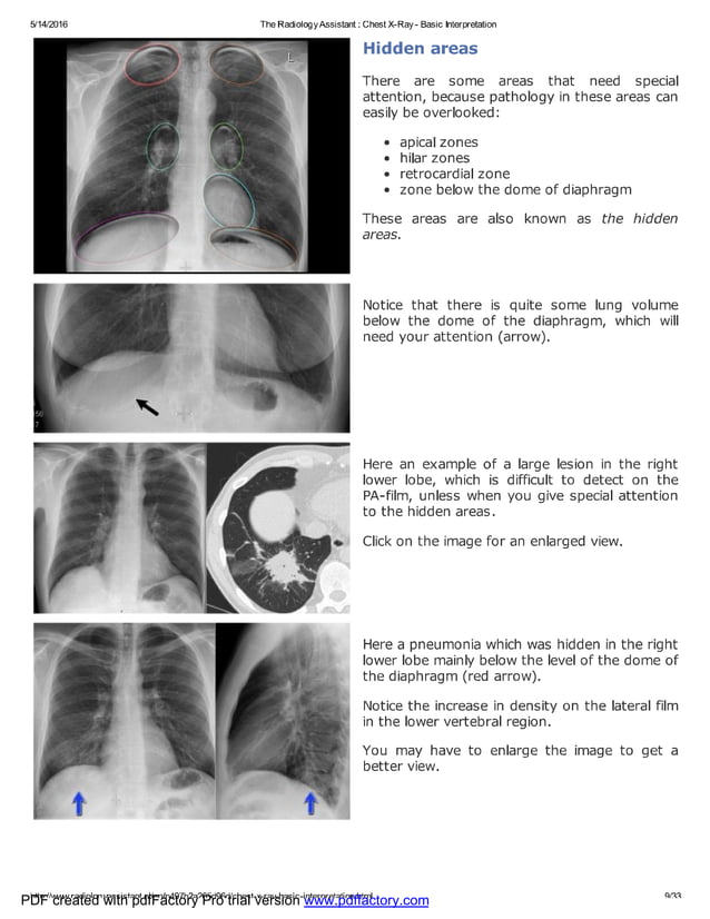 Chest x ray - basic interpretation | PDF