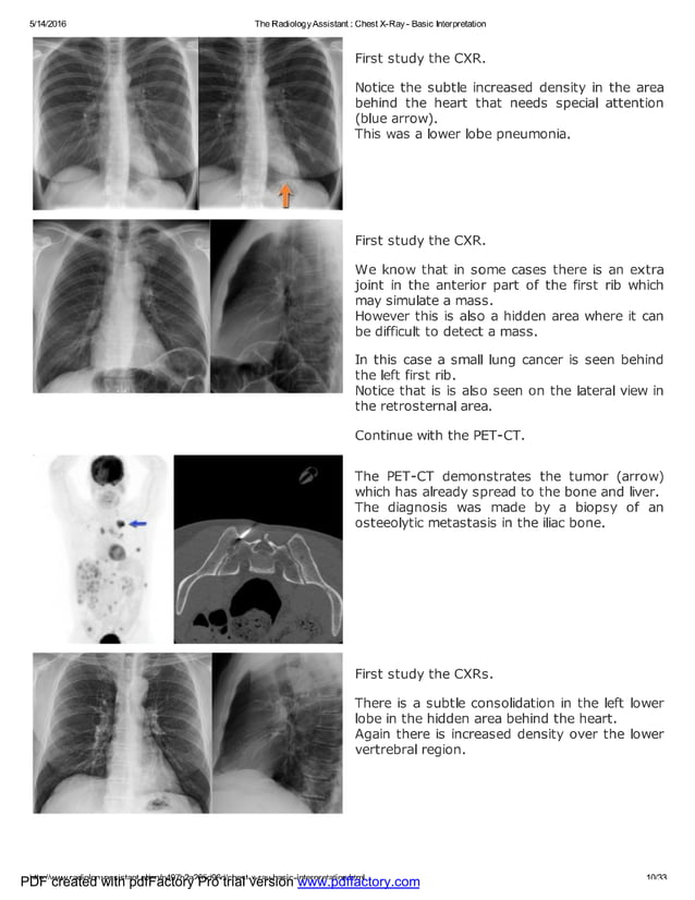 Chest x ray - basic interpretation