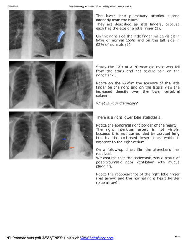 Chest x ray - basic interpretation