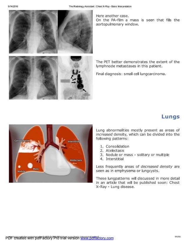 Chest x ray - basic interpretation