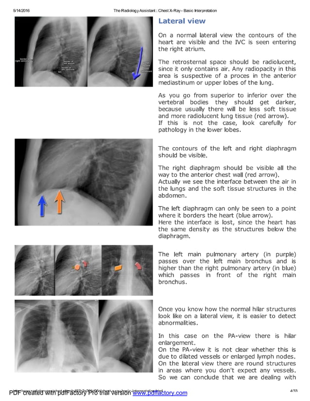Chest x ray - basic interpretation