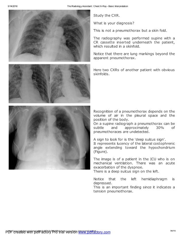 Chest x ray - basic interpretation