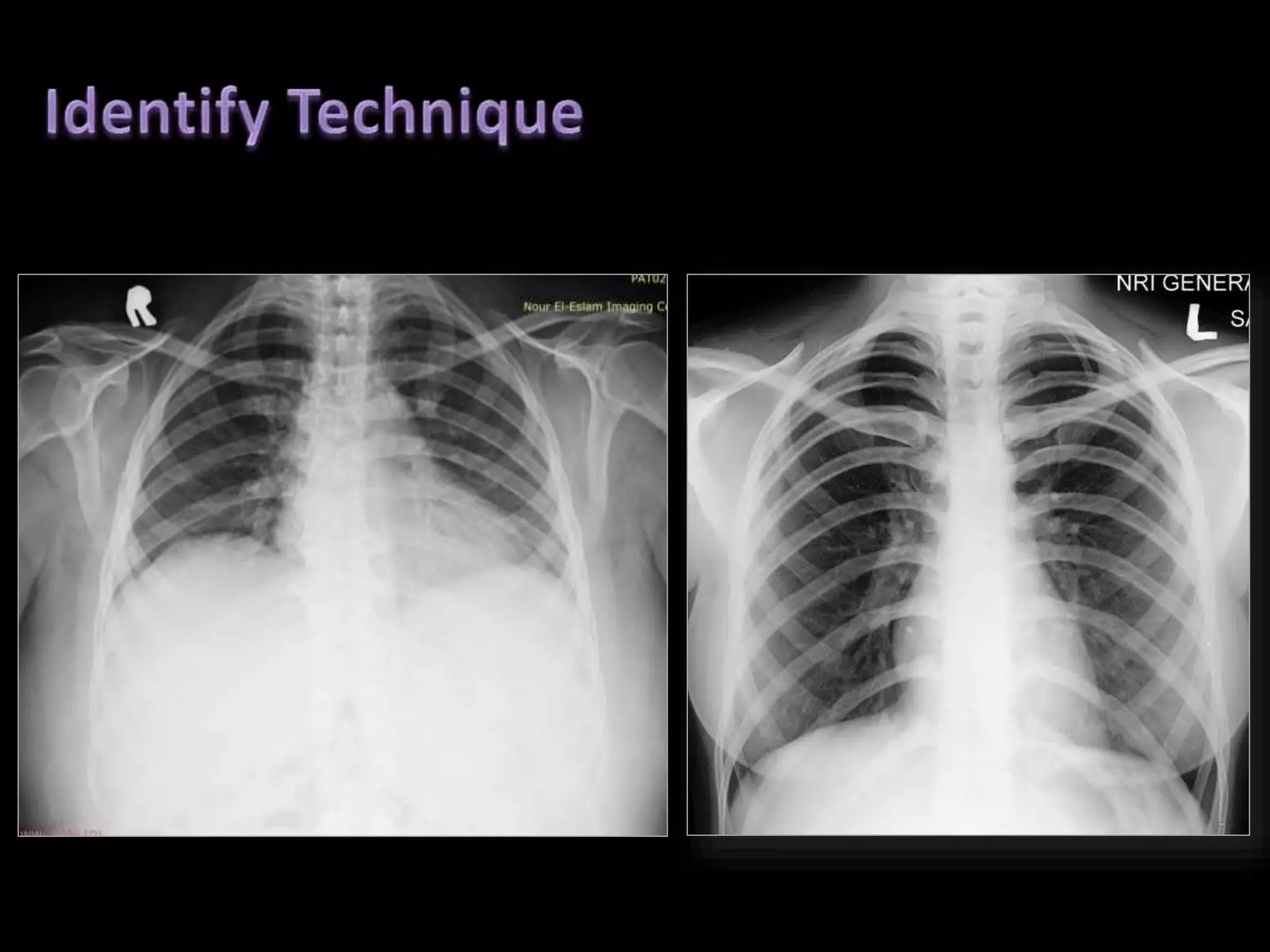 Chest x ray - basic principles and interpretition | PPTX