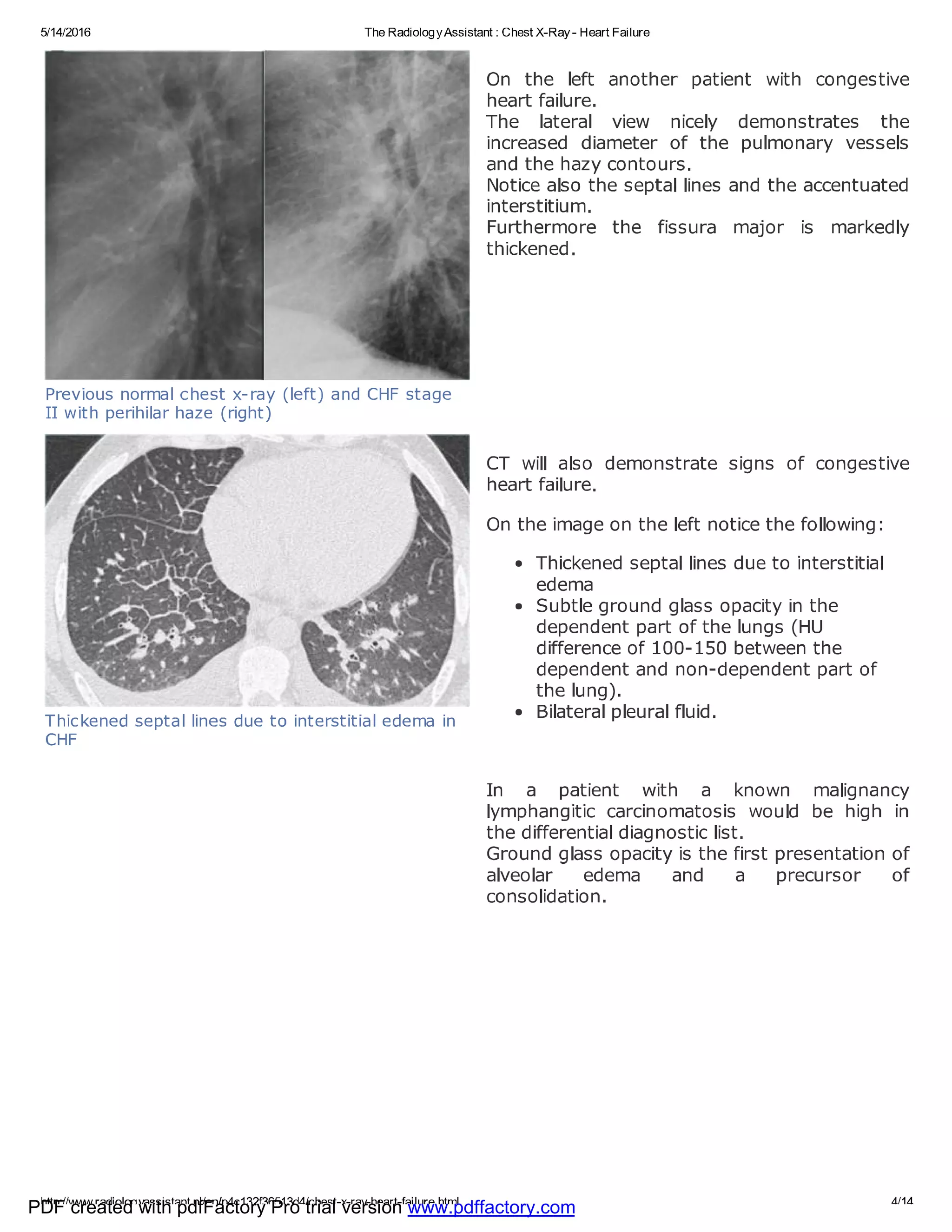 Chest x ray - heart failure | PDF