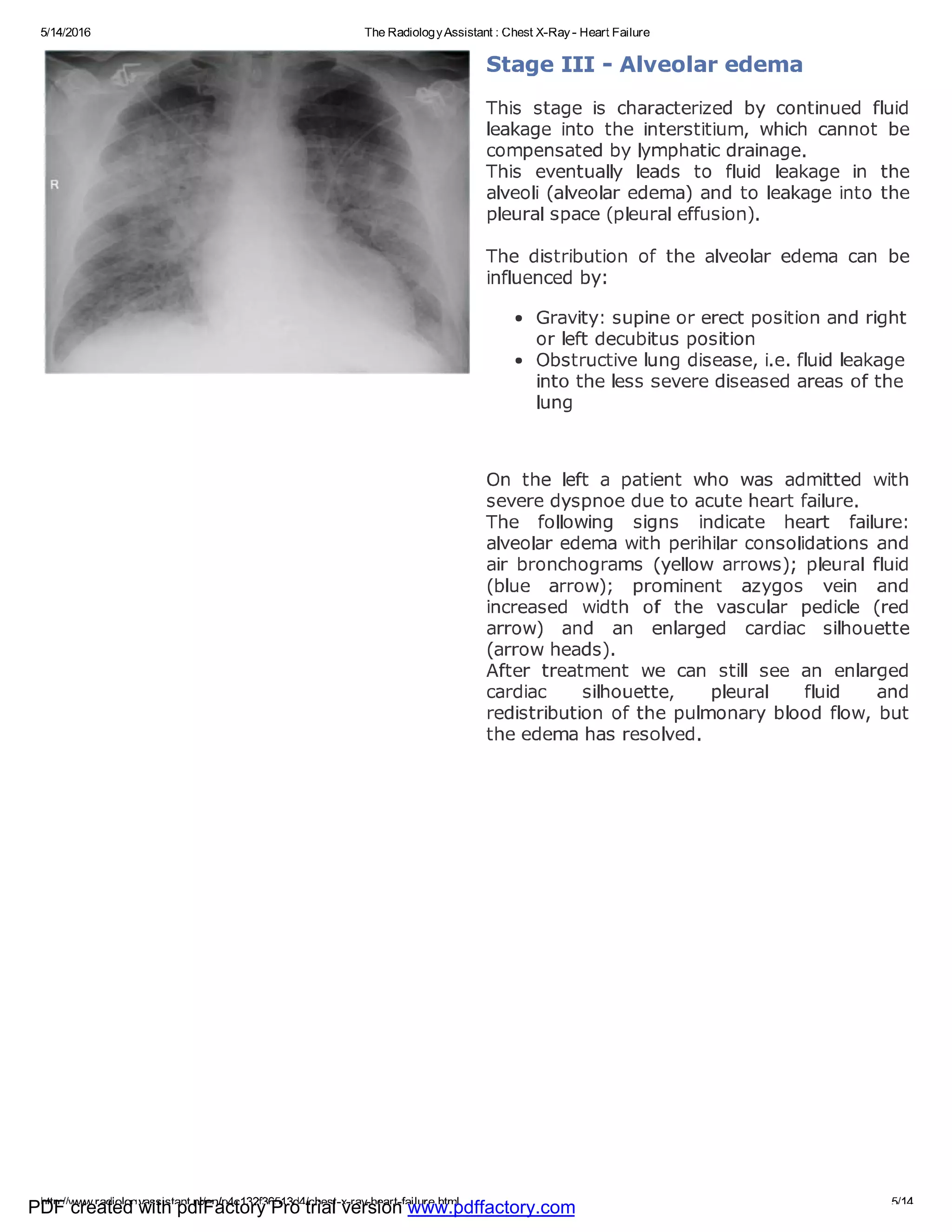 Chest x ray - heart failure | PDF