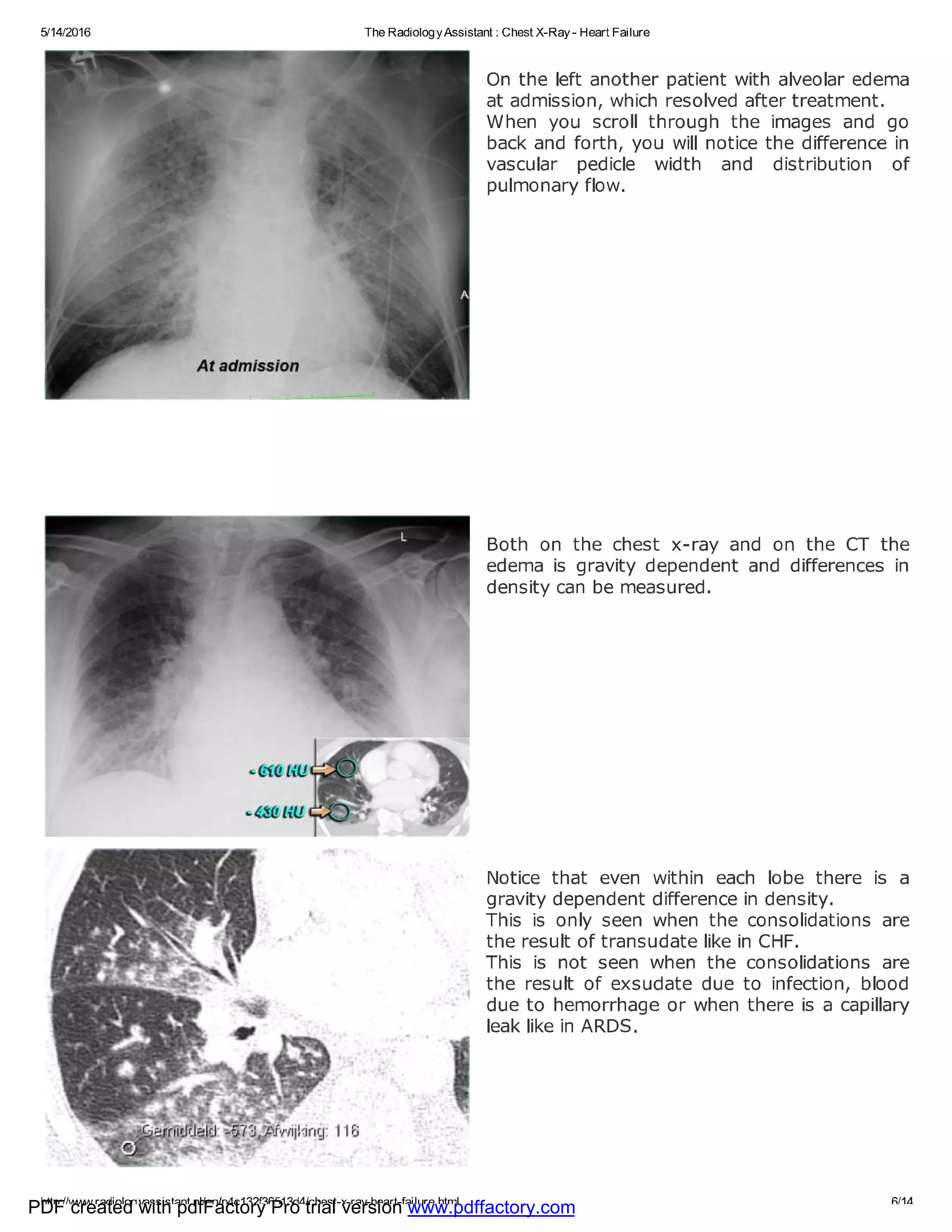 Chest x ray - heart failure | PDF