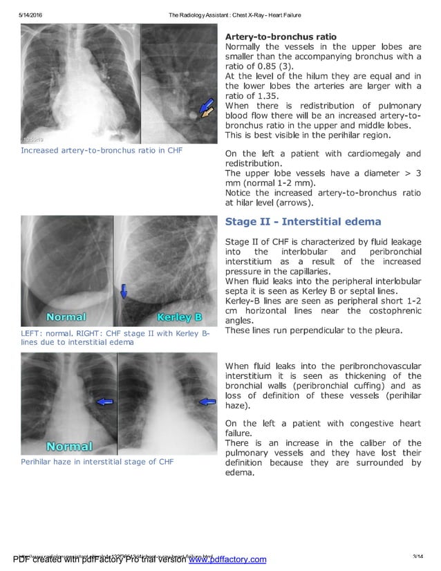 Chest x ray - heart failure | PDF