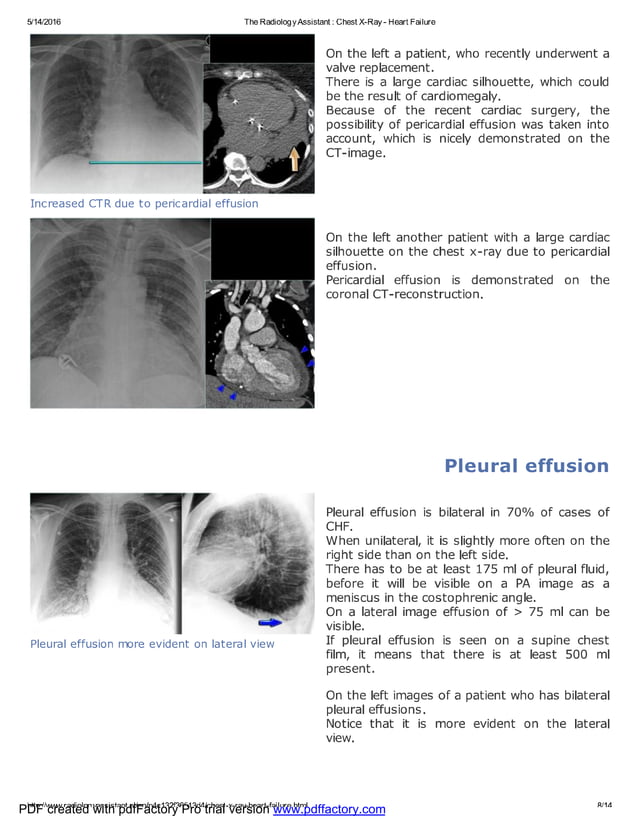 Chest x ray - heart failure | PDF