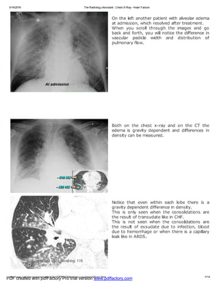 X Ray Heart Failure