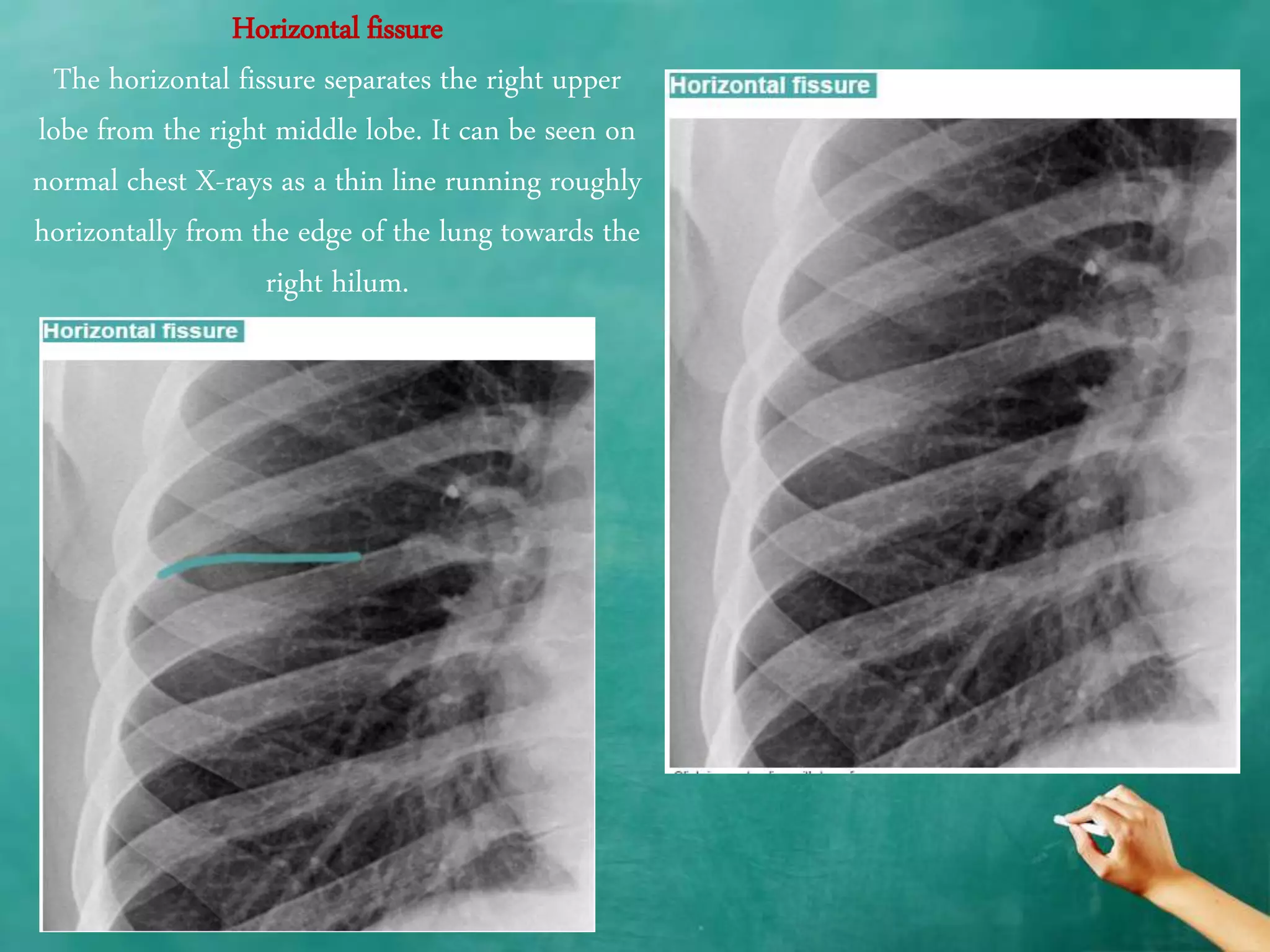 Chest x ray anatomy - how to interpret chest x-ray (2) | PPTX