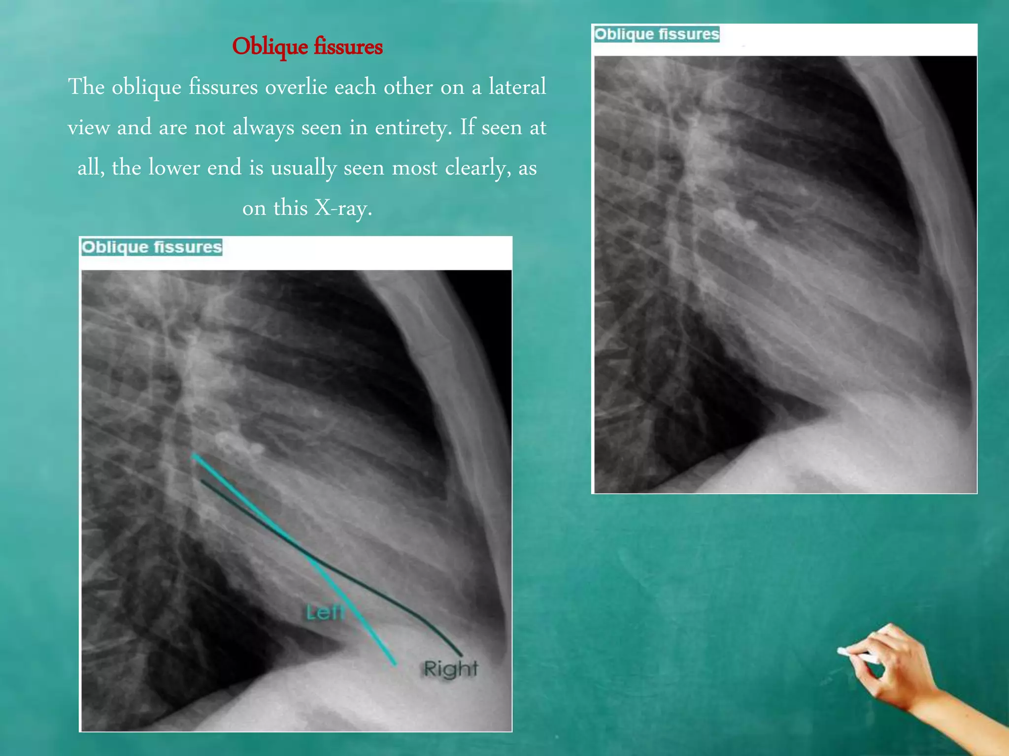 Chest x ray anatomy - how to interpret chest x-ray (2) | PPTX