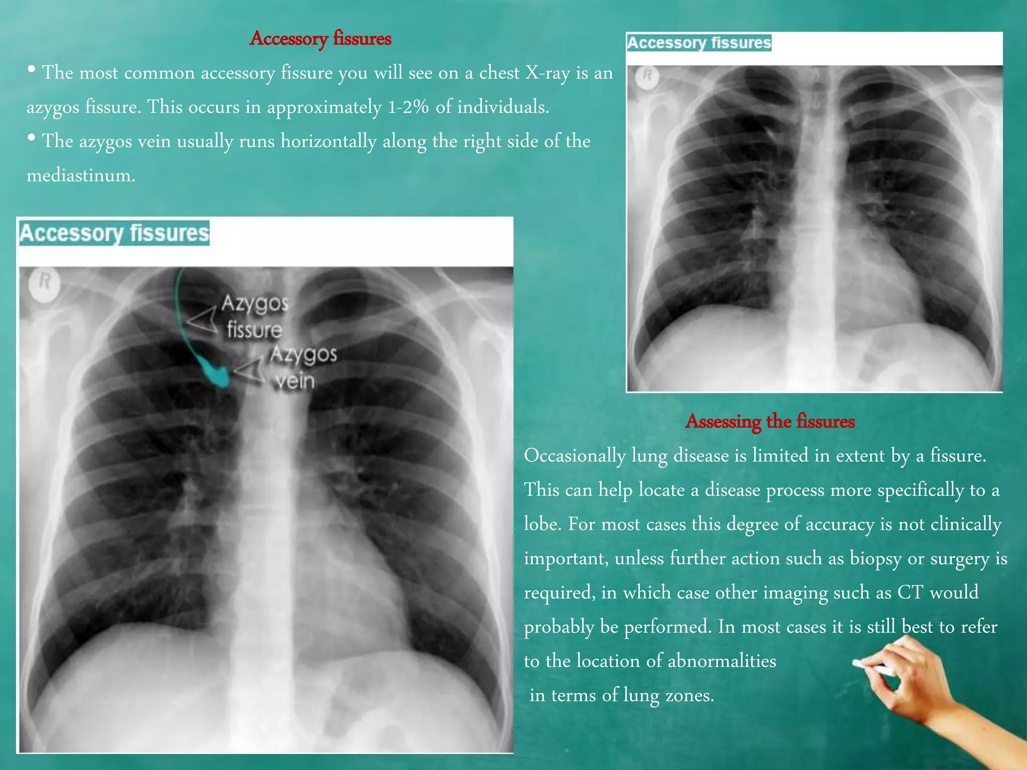 Chest x ray anatomy - how to interpret chest x-ray (2) | PPTX