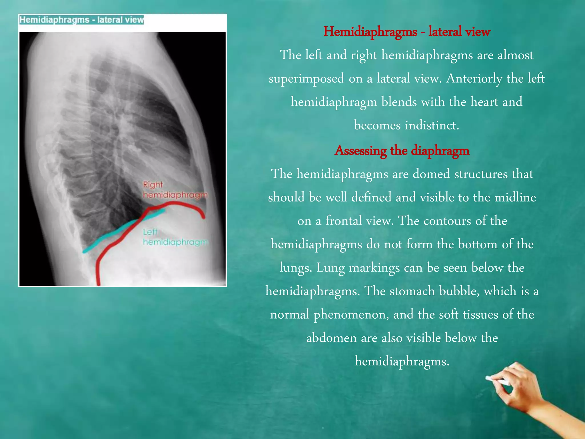 Chest x ray anatomy - how to interpret chest x-ray (2) | PPTX