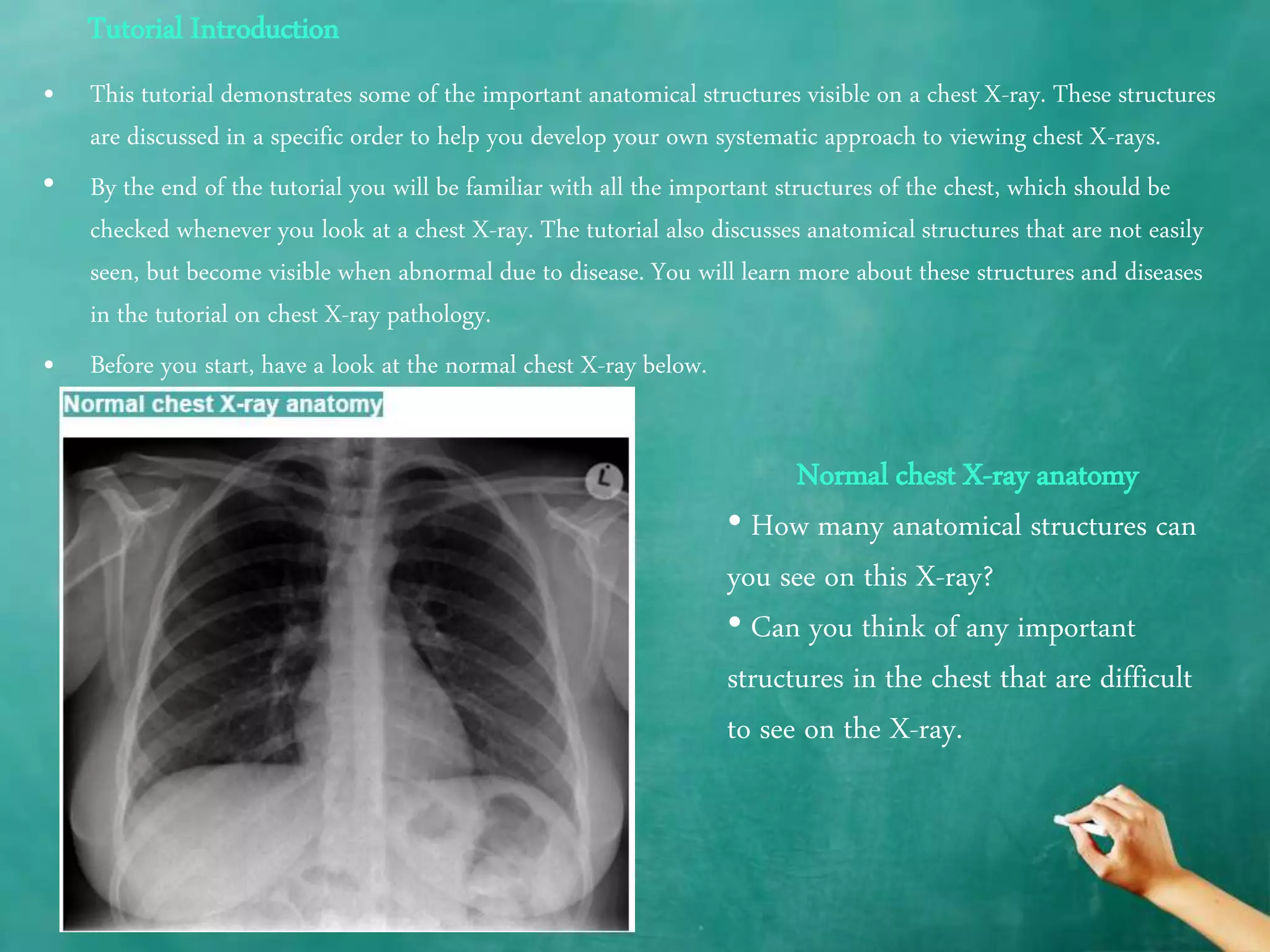 Chest x ray anatomy - how to interpret chest x-ray (2) | PPTX