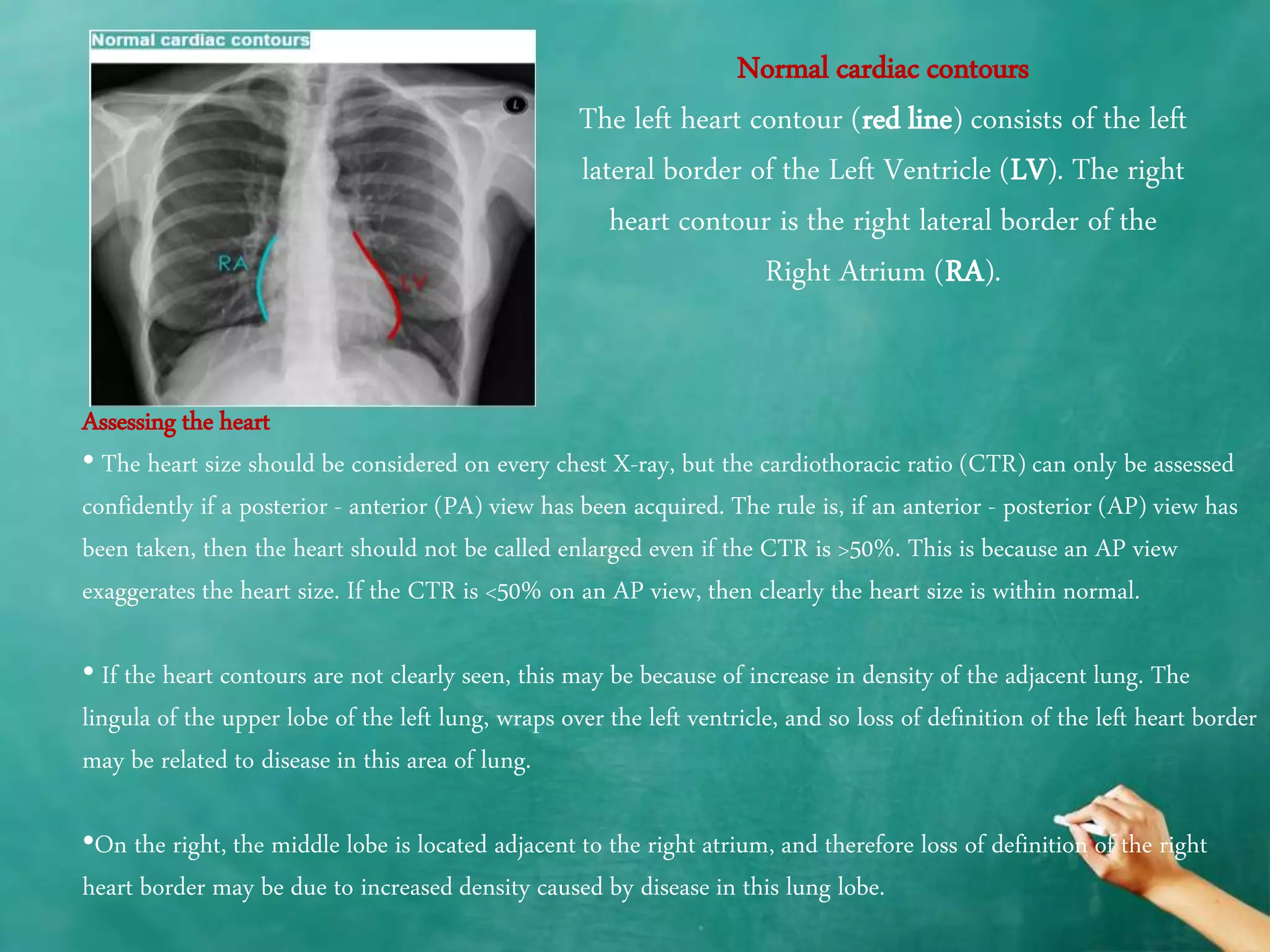 Chest x ray anatomy - how to interpret chest x-ray (2) | PPTX