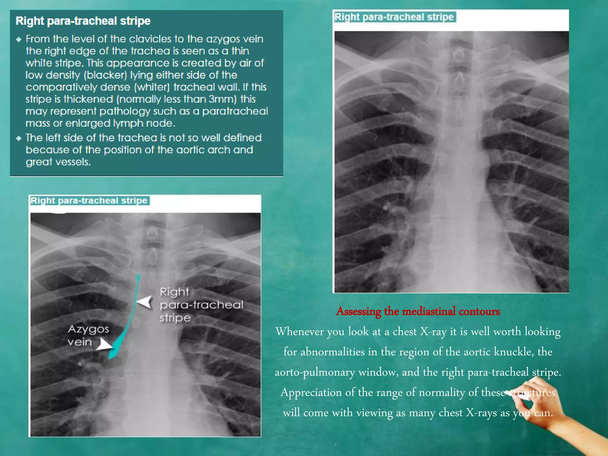 Chest x ray anatomy - how to interpret chest x-ray (2) | PPTX