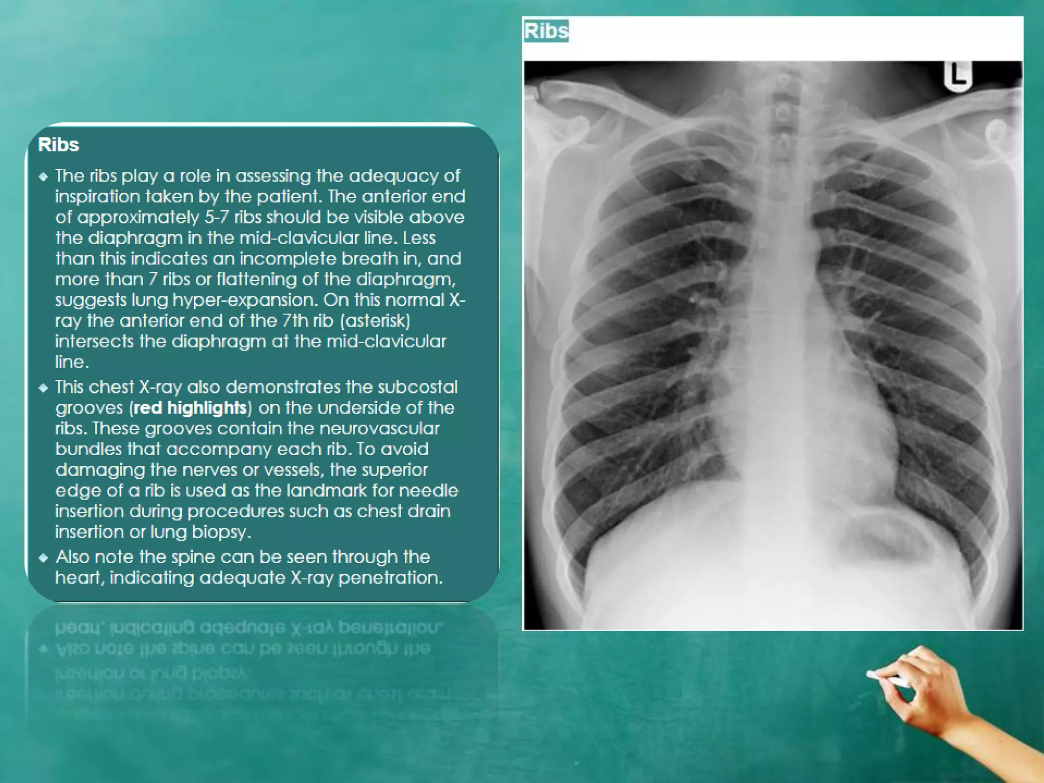 Chest x ray anatomy - how to interpret chest x-ray (2) | PPTX
