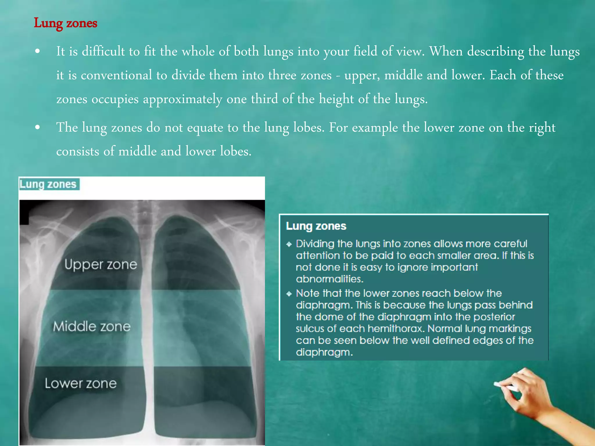 Chest x ray anatomy - how to interpret chest x-ray (2) | PPTX