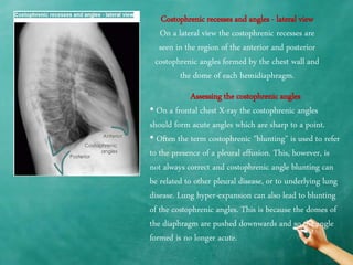 Chest x ray anatomy - how to interpret chest x-ray (2) | PPTX