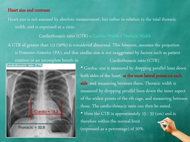 Chest x ray anatomy - how to interpret chest x-ray (2) | PPTX
