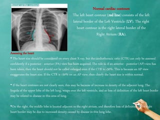 Chest x ray anatomy - how to interpret chest x-ray (2) | PPTX