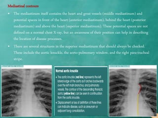 Chest x ray anatomy - how to interpret chest x-ray (2) | PPTX