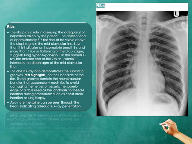 Chest x ray anatomy - how to interpret chest x-ray (2) | PPTX