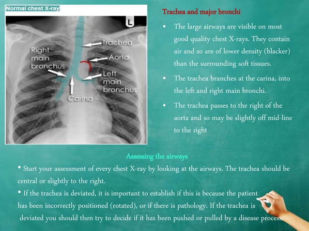 Chest x ray anatomy - how to interpret chest x-ray (2) | PPTX