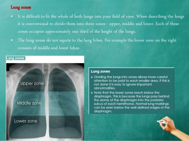 Chest x ray anatomy - how to interpret chest x-ray (2)