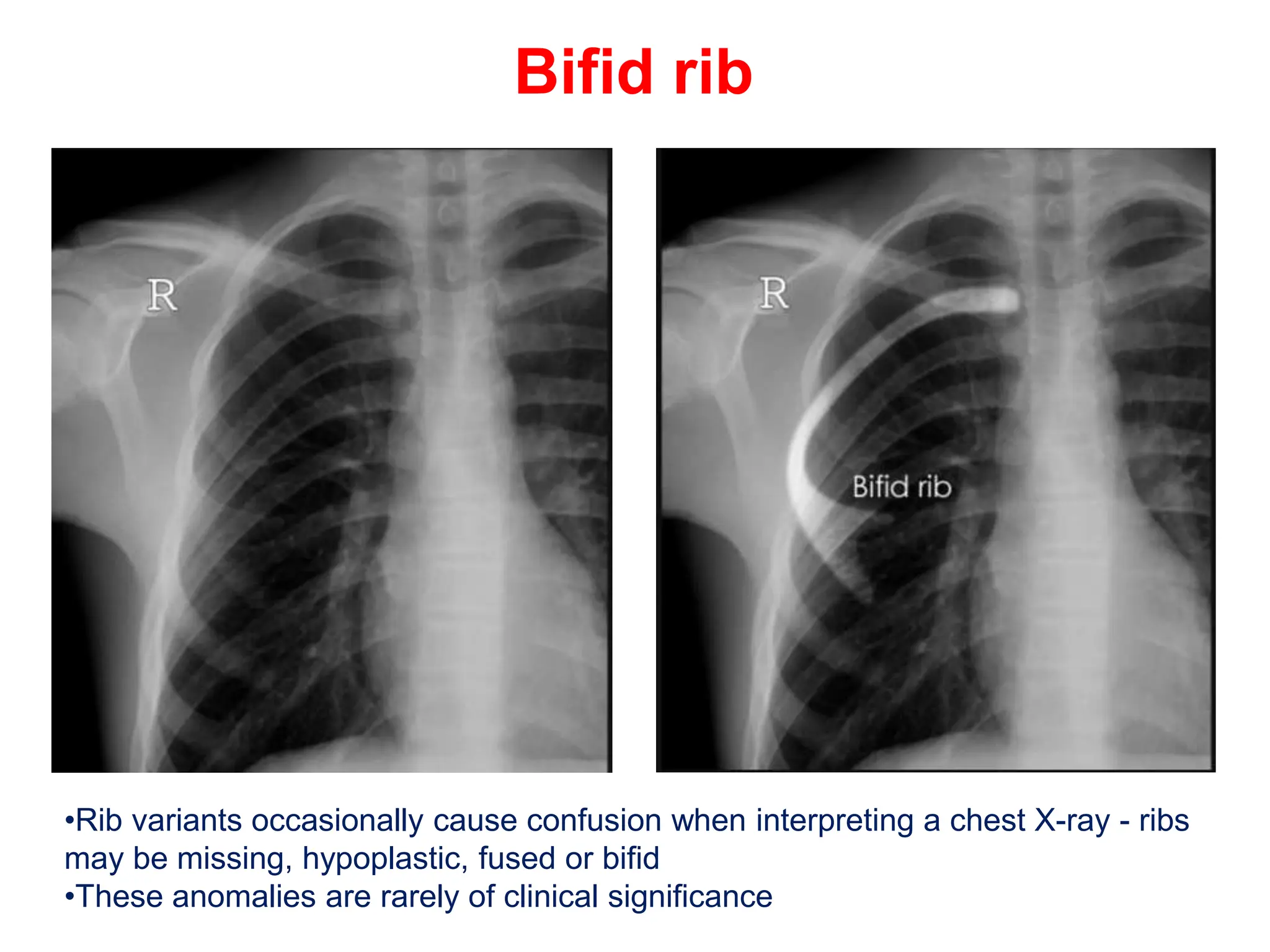 CHESTX-RAY ANATOMICAL VARIANTS......pptx