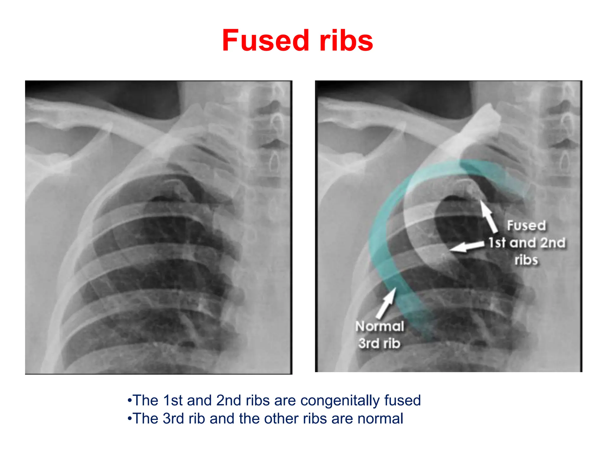 CHESTX-RAY ANATOMICAL VARIANTS......pptx