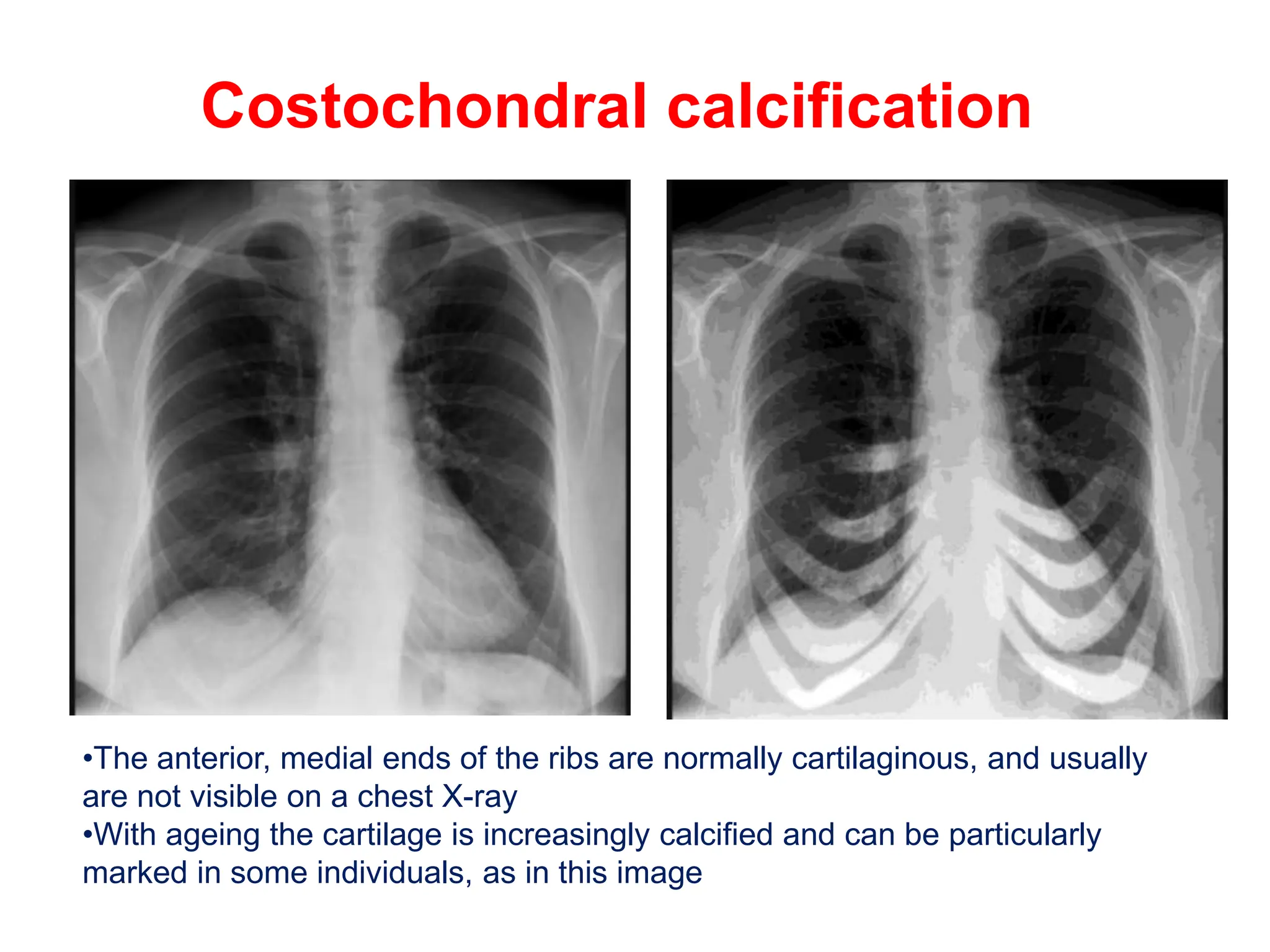 CHESTX-RAY ANATOMICAL VARIANTS......pptx