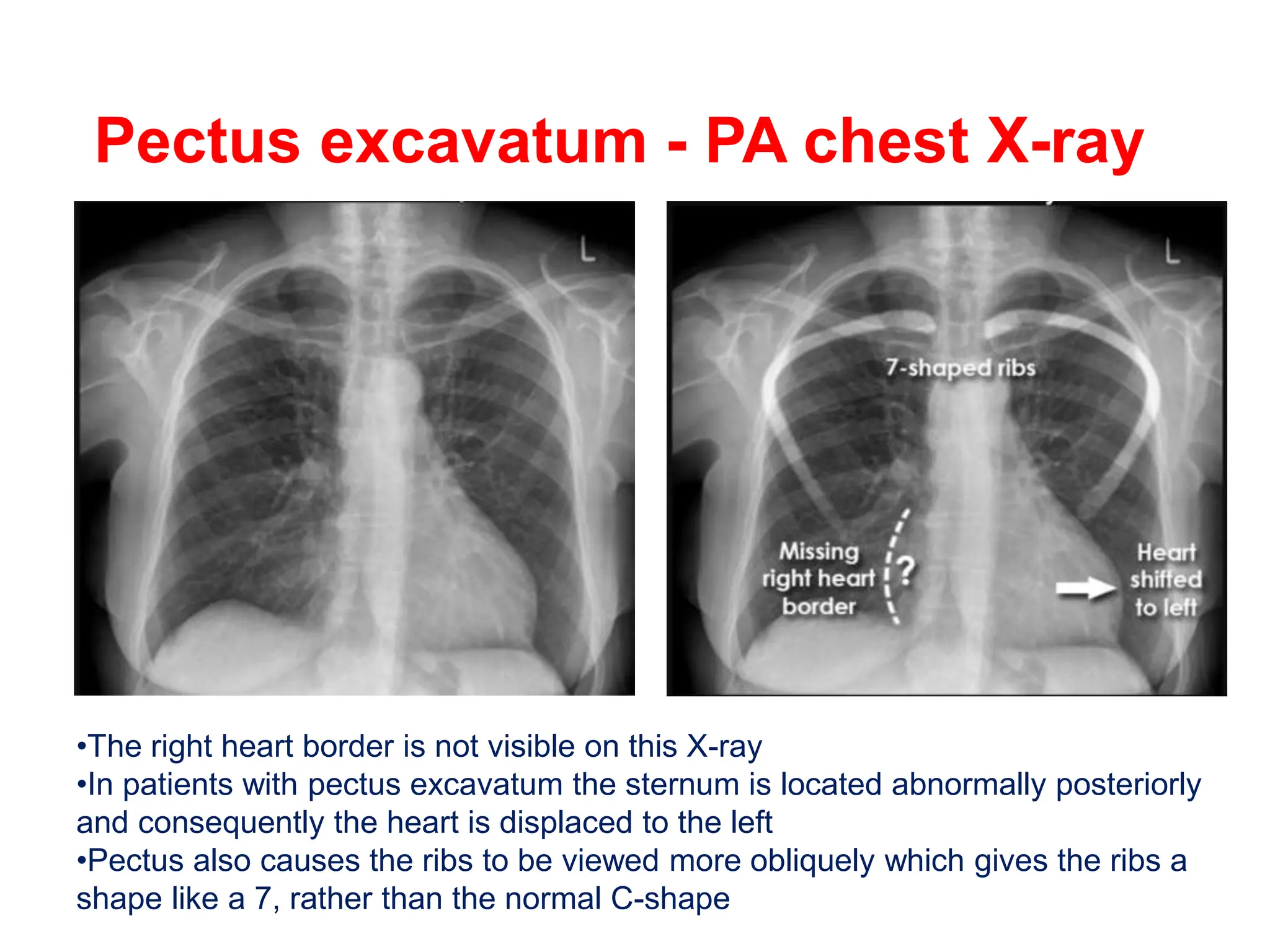 CHESTX-RAY ANATOMICAL VARIANTS......pptx