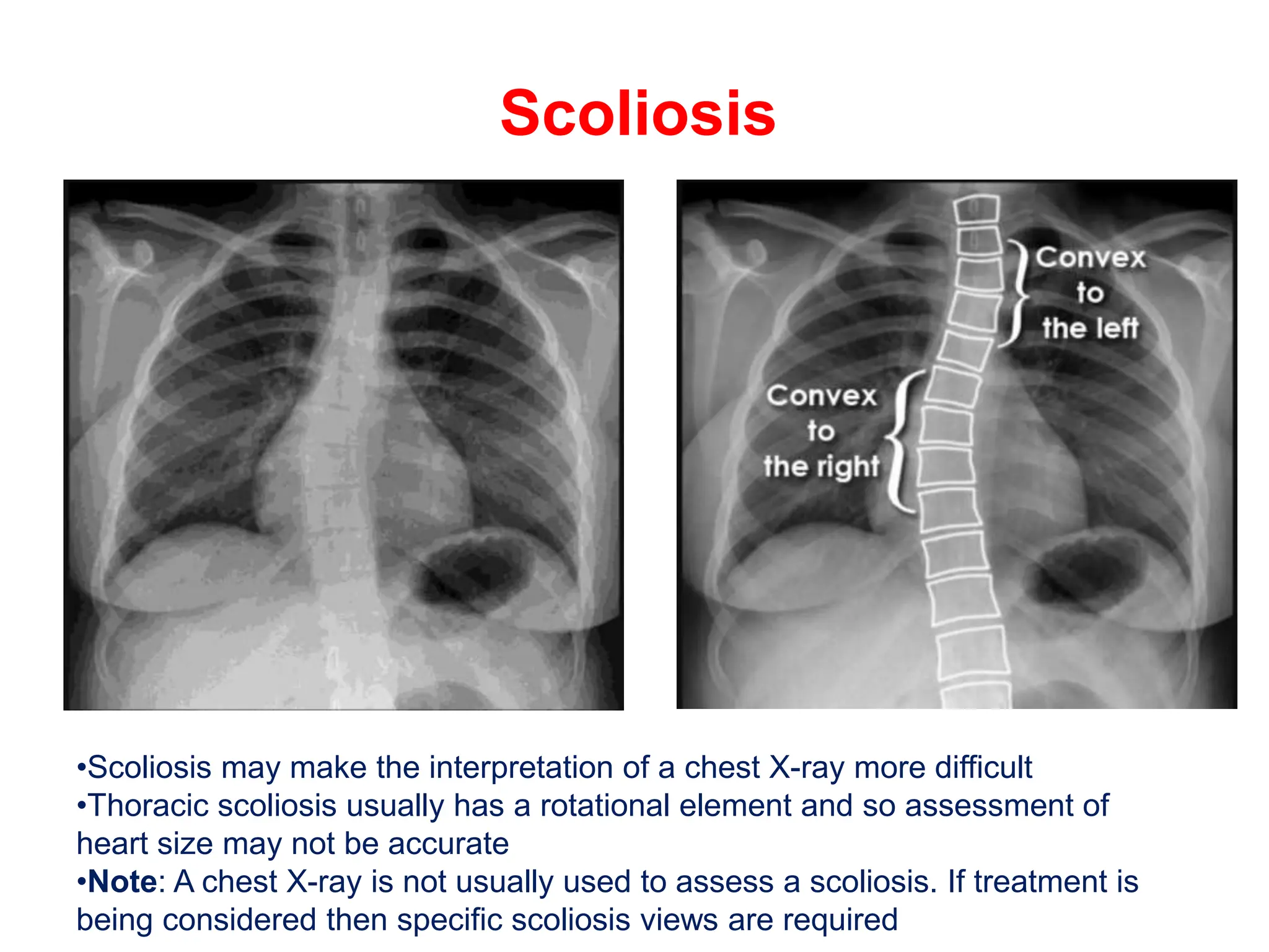 CHESTX-RAY ANATOMICAL VARIANTS......pptx