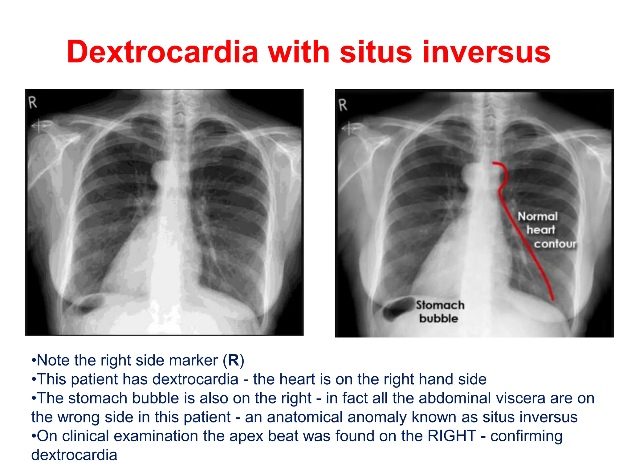 CHESTX-RAY ANATOMICAL VARIANTS......pptx