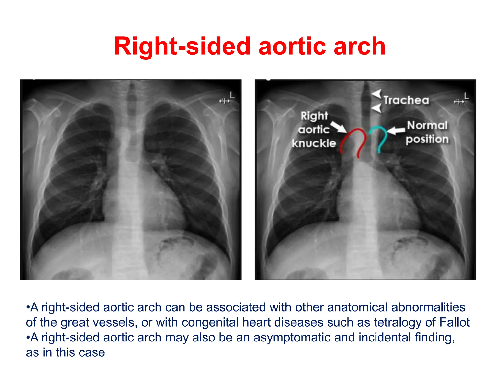 CHESTX-RAY ANATOMICAL VARIANTS......pptx