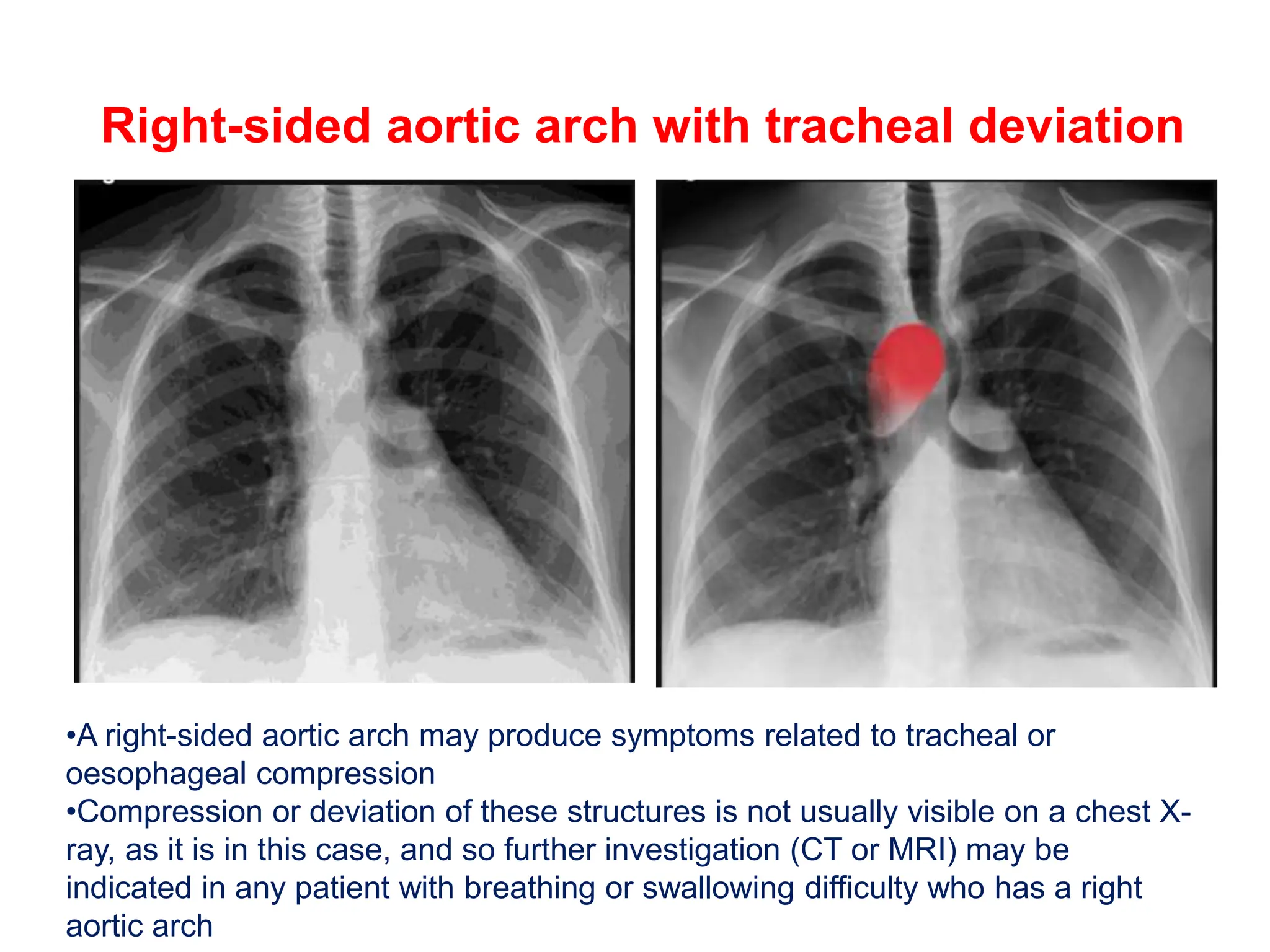 CHESTX-RAY ANATOMICAL VARIANTS......pptx