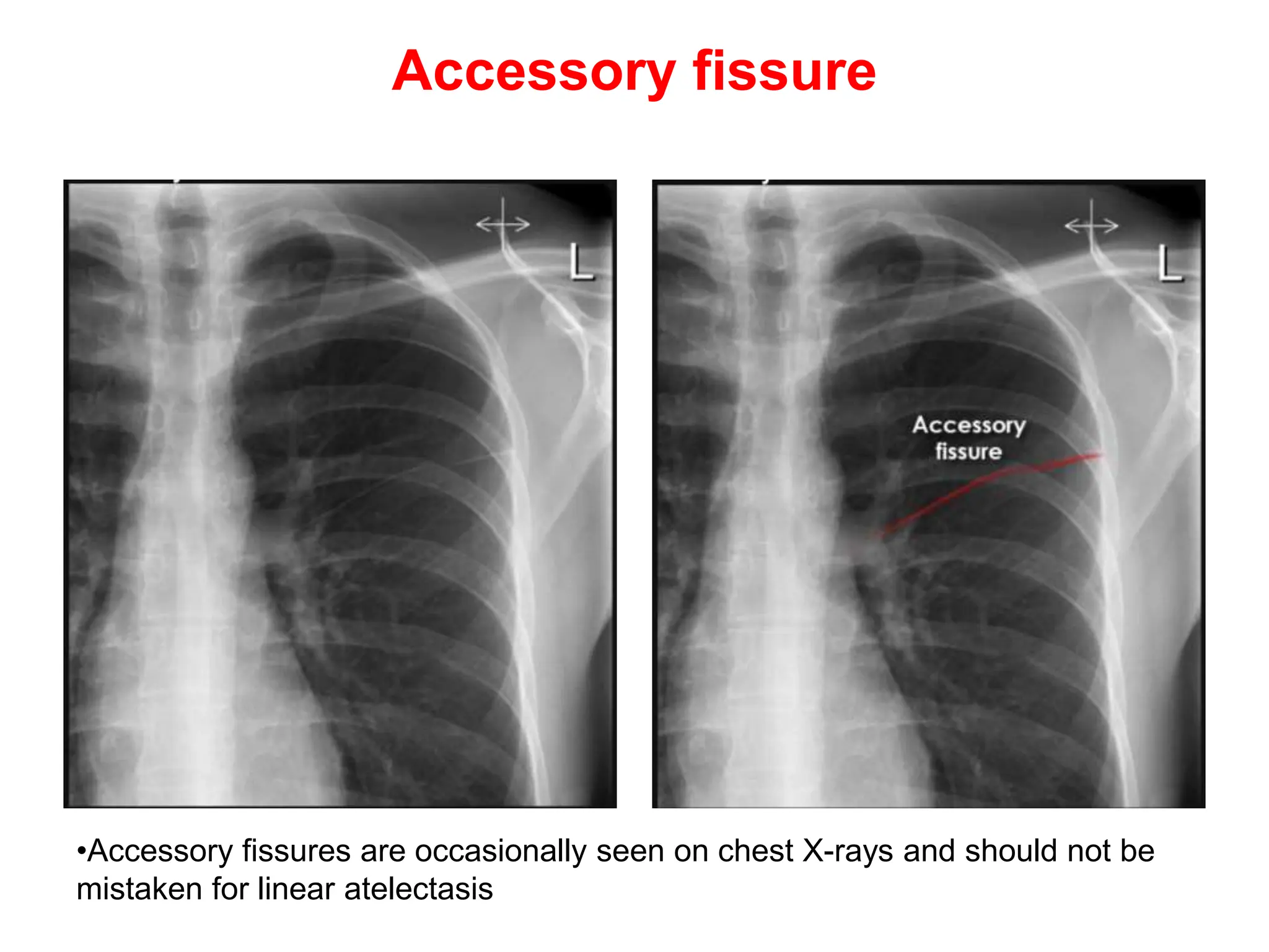 CHESTX-RAY ANATOMICAL VARIANTS......pptx