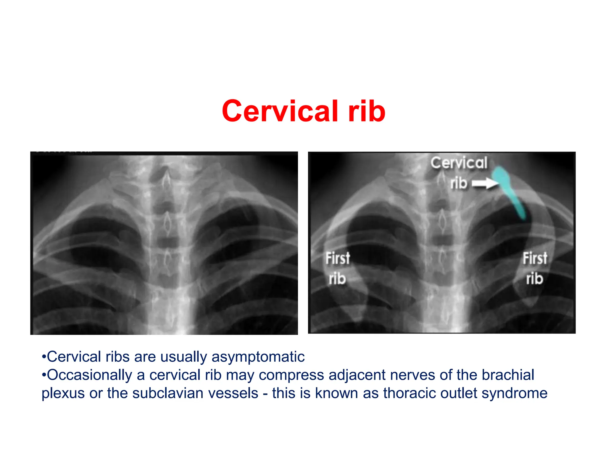 CHESTX-RAY ANATOMICAL VARIANTS......pptx